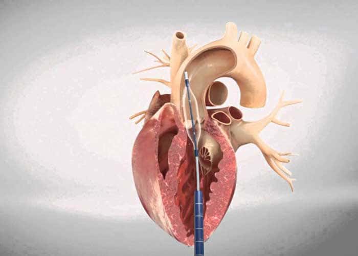 Do You Need Complete Rest After TAVI Surgery?