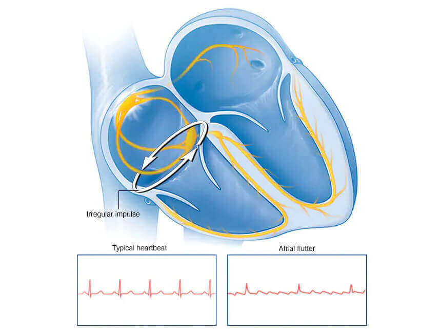 Best Atrial Flutter Treatment In Hyderabad | Dr.Sudheer Best Atrial Flutter Treatment In Hyderabad | Dr.Sudheer